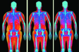 Dexa and Body Fat Composition | Serene Diagnostic Imaging